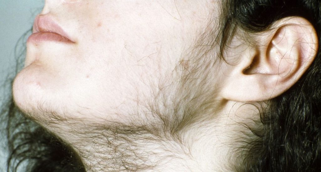 Bahaya Atau Tidak Wanita Bermisai & Berbulu Tebal! Kenali Sindrom Hirsutism