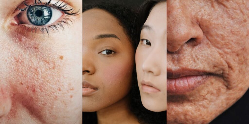 Kulit Wajah ‘Berlubang’, Ini Jenis-Jenis Parut Jerawat Perlu Korang Tahu