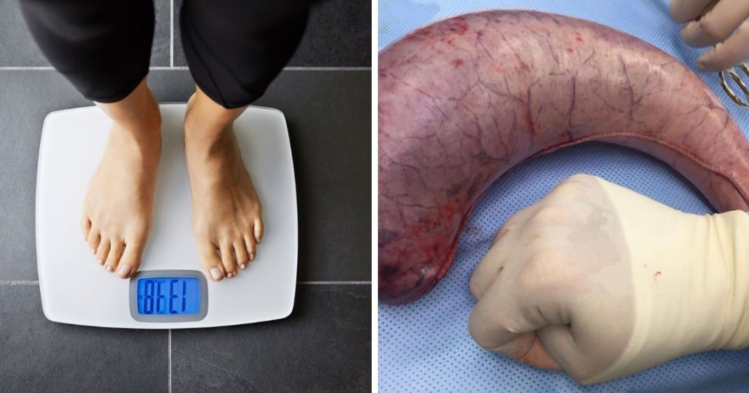 Pembedahan Pintasan Perut Untuk Cepat Kurus, Ini Hukum Yang Korang ...